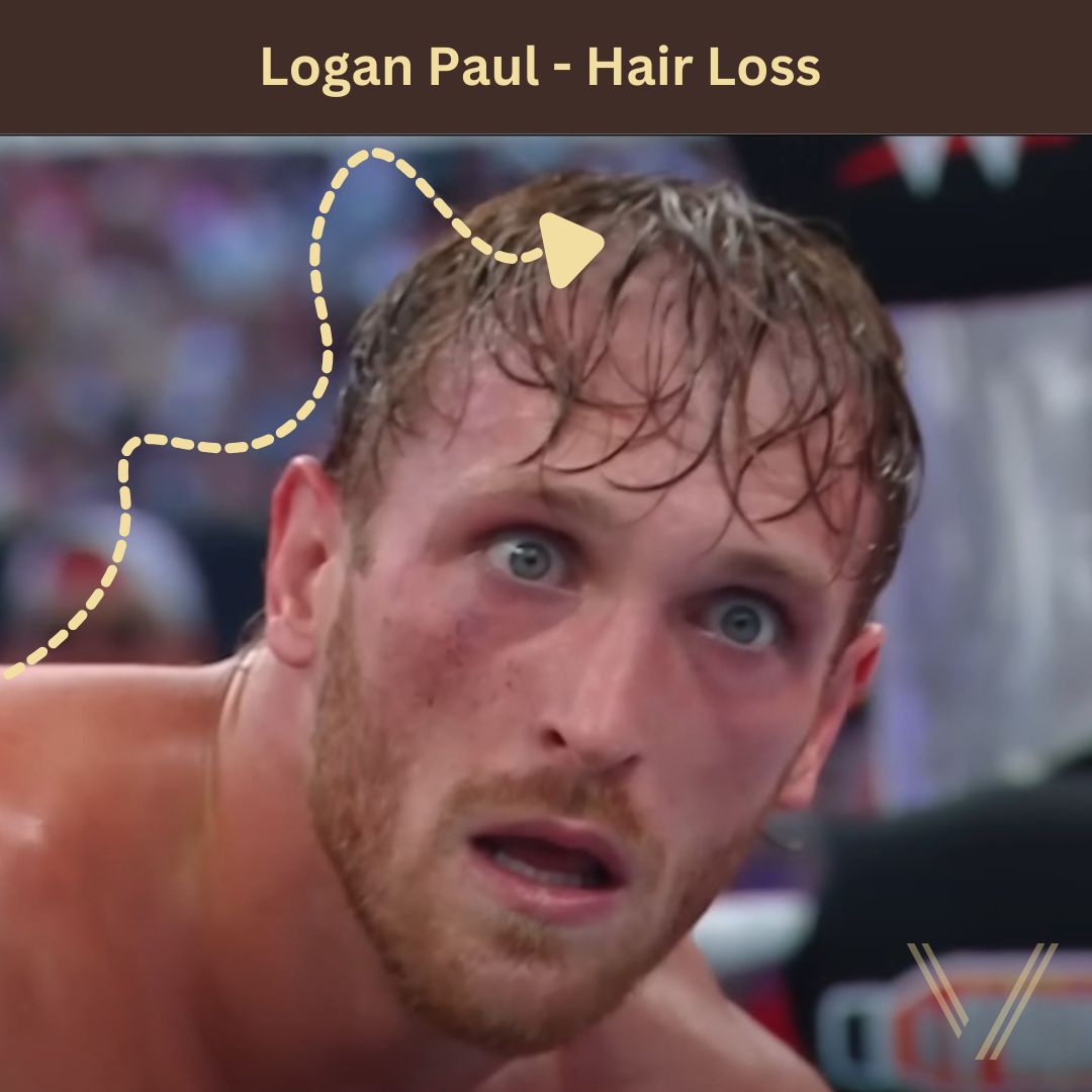 Logan Paul Hair Transplant