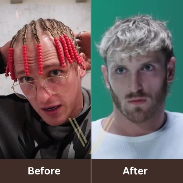 Logan Paul Hair Transplant