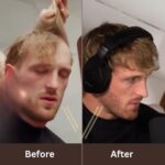 Logan Paul Hair Transplant