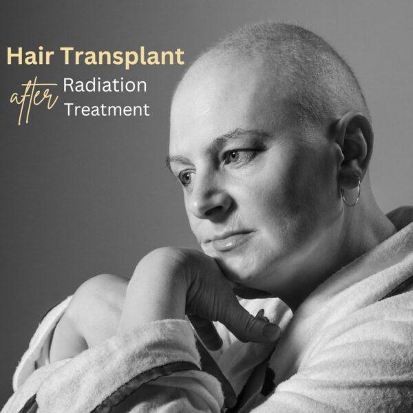 Hair Transplant After Radiation Treatment | Vantage Hair Transplant ...