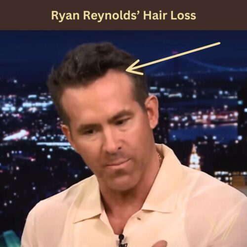 Ryan Reynolds Hair Transplant - Before After - Vantage Hair Clinic