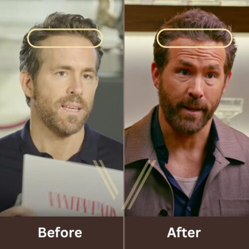 Ryan Reynolds Hair Transplant - Before After - Vantage Hair Clinic