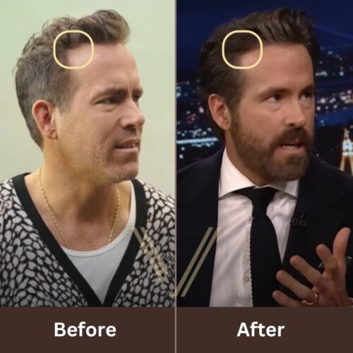 Ryan Reynolds Hair Transplant - Before After - Vantage Hair Clinic