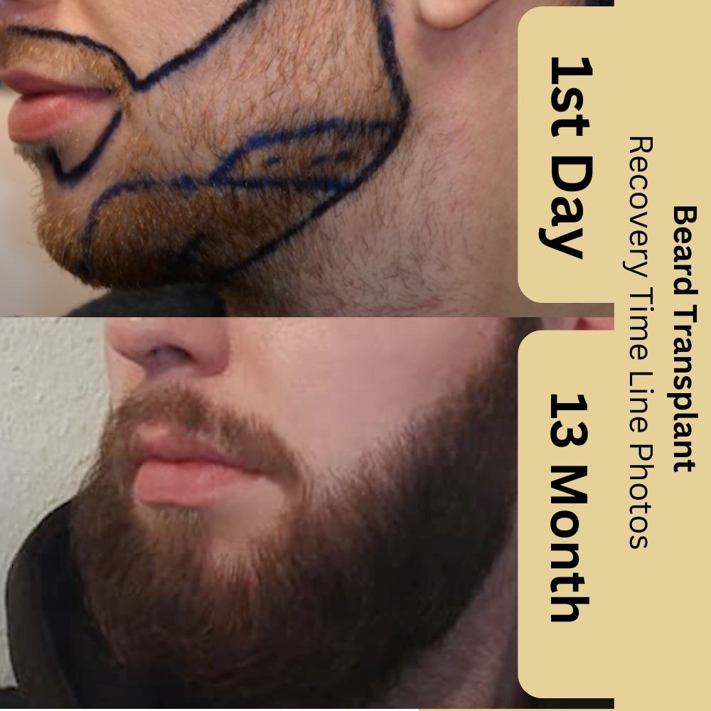 Beard Transplant Growth by Days, Weeks and Months - Vantage
