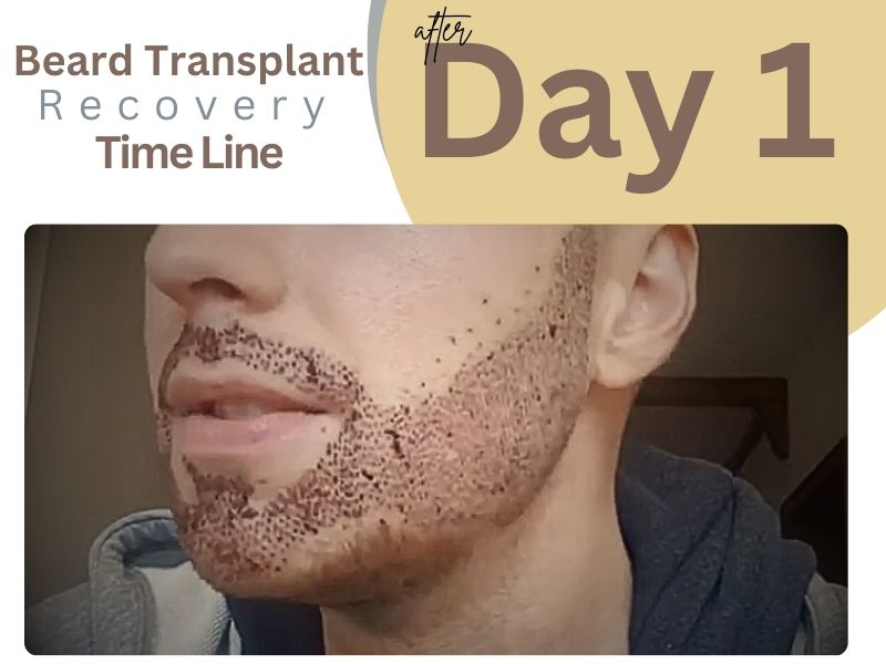 Beard Transplant Growth by Days, Weeks and Months - Vantage