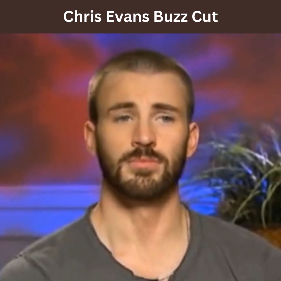 Chris Evans Hair Transplant - Before and After Result