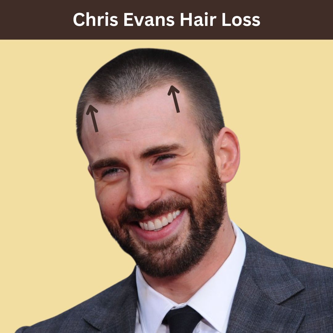 Chris Evans Hair Transplant - Before and After Result