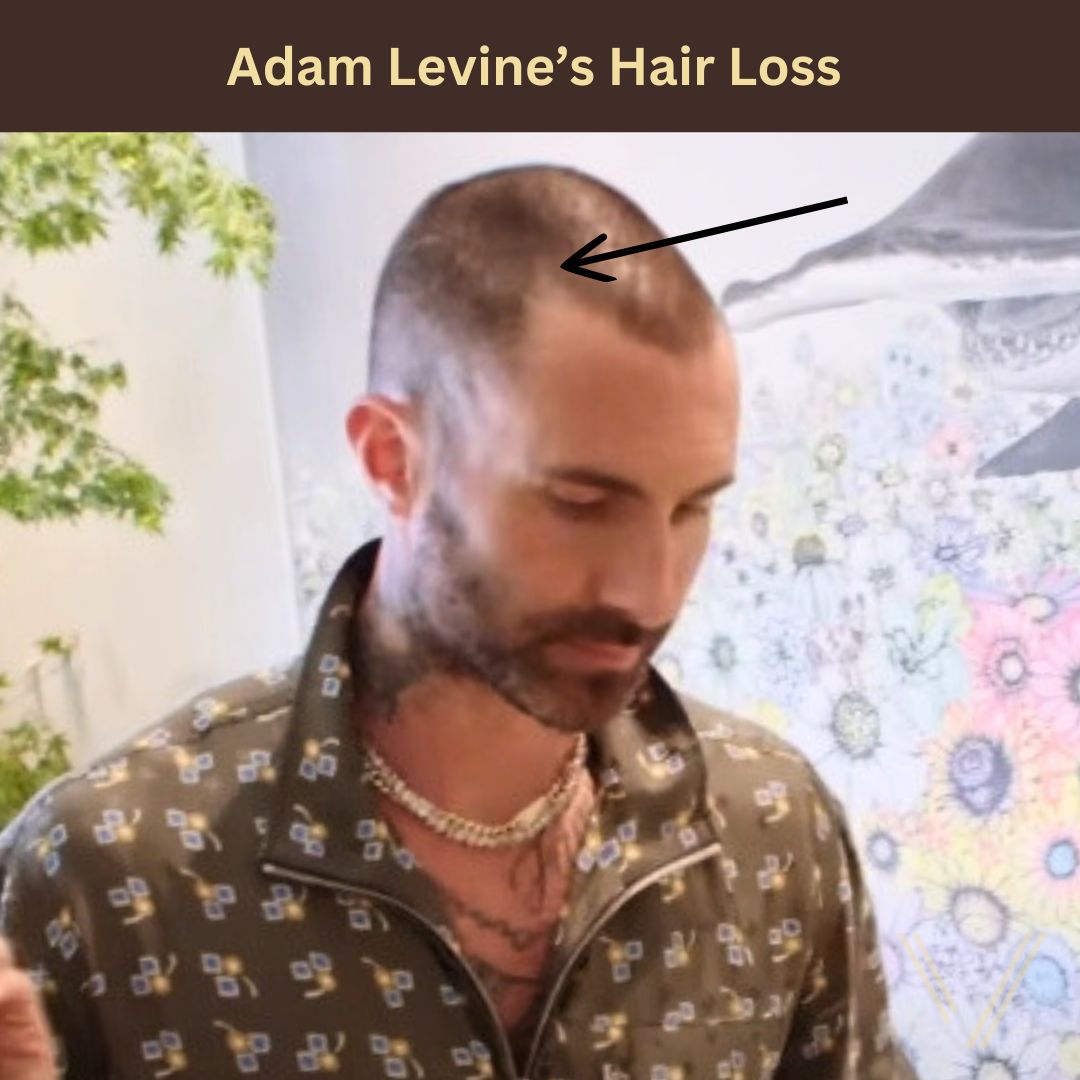Adam Levine Hair Transplant: Before and After Transformation