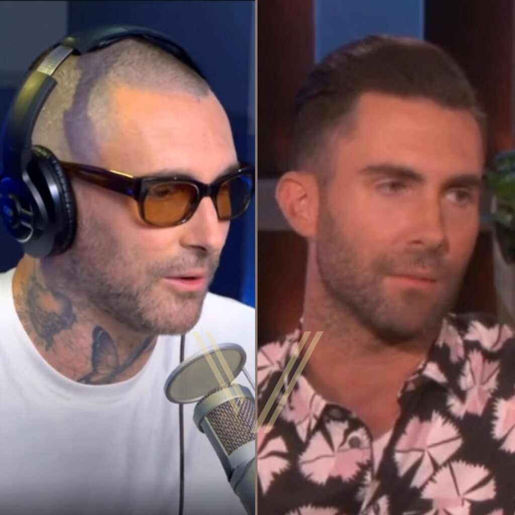 Adam Levine Hair Transplant: Before and After Transformation