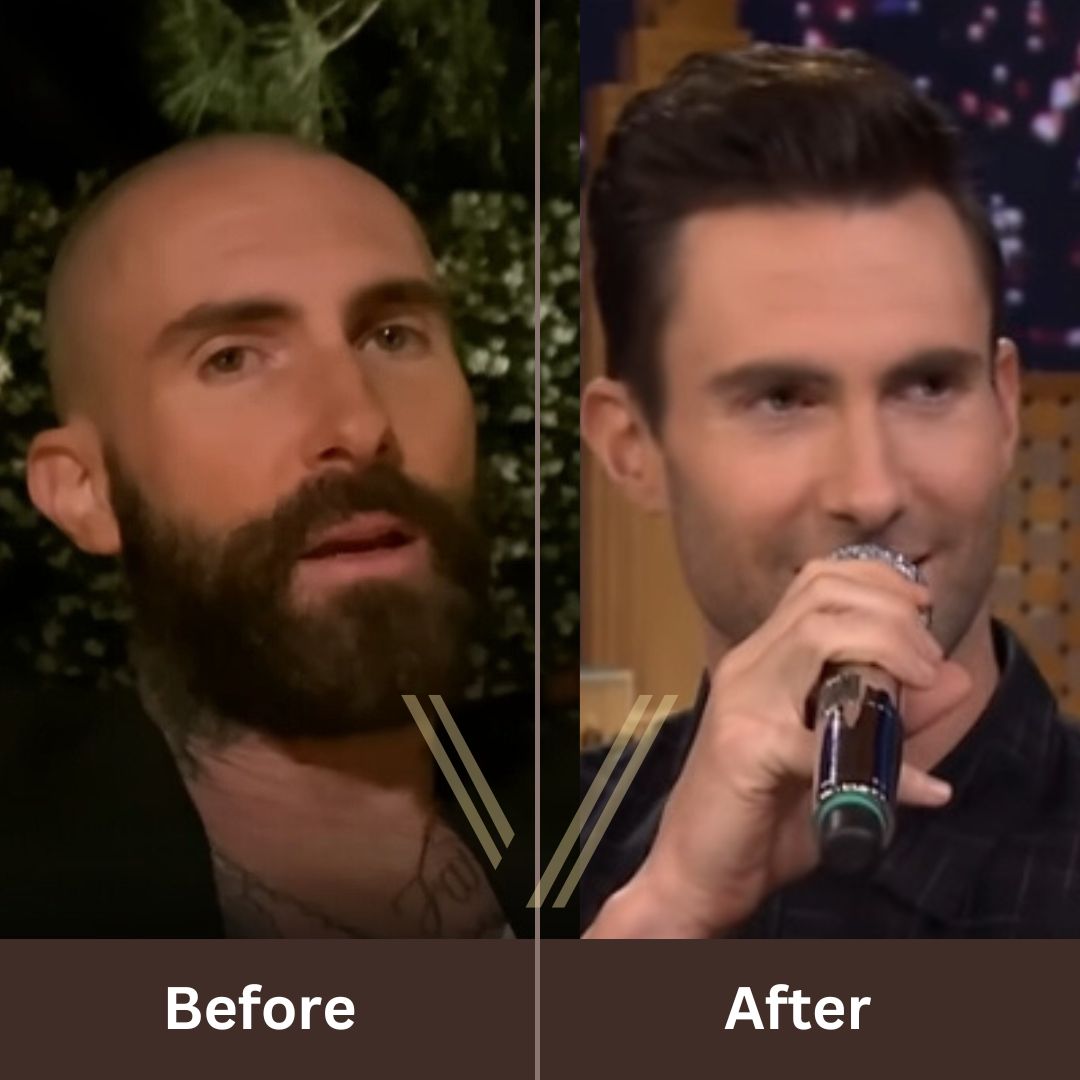 Adam Levine Hair Transplant: Before and After Transformation