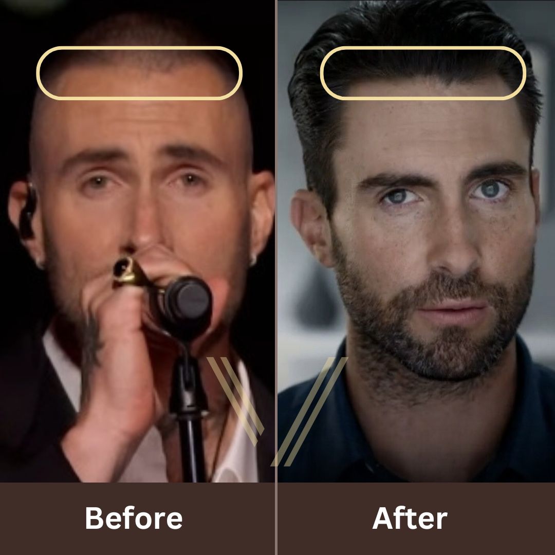 Adam Levine Hair Transplant: Before and After Transformation