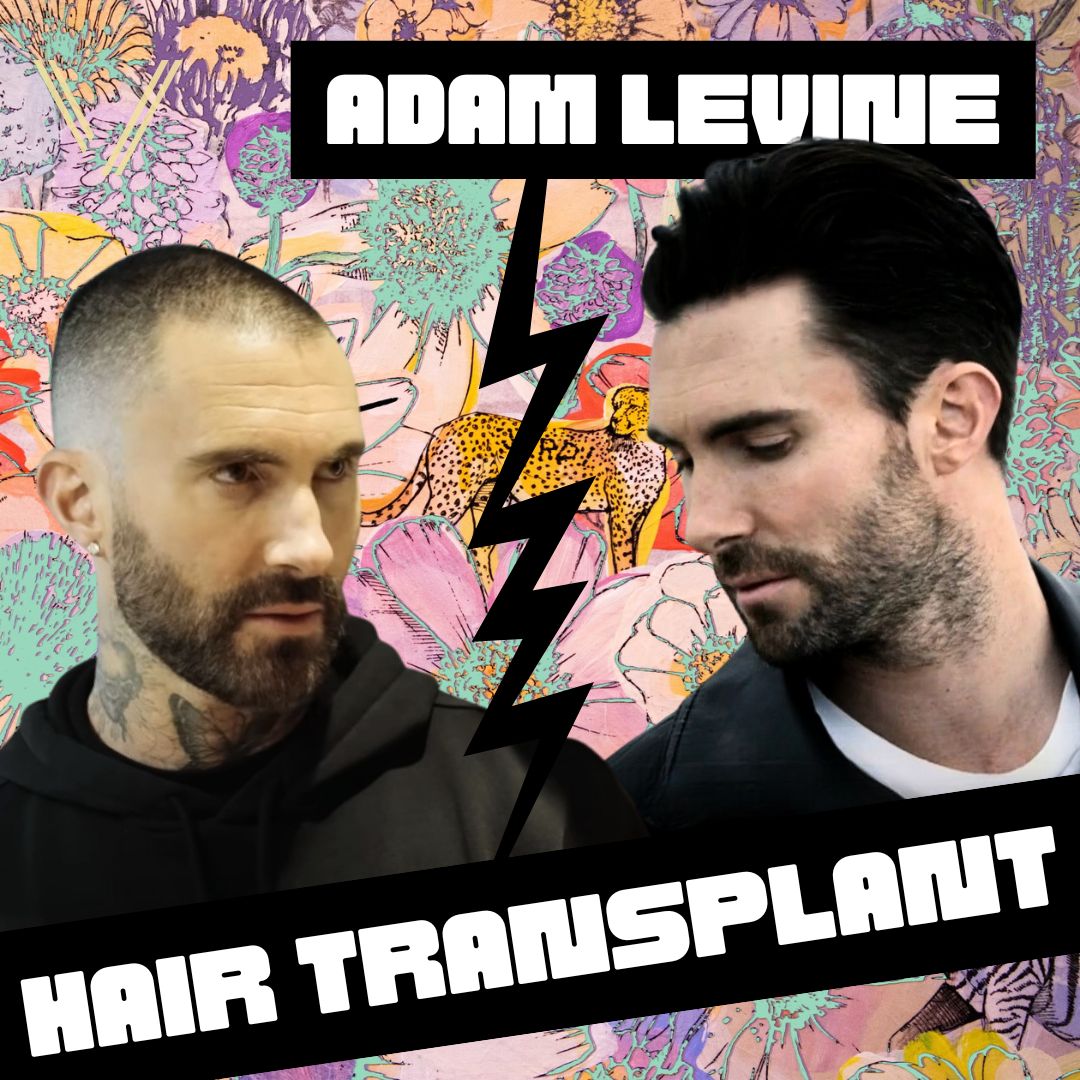 Adam Levine Hair Transplant: Before and After Transformation