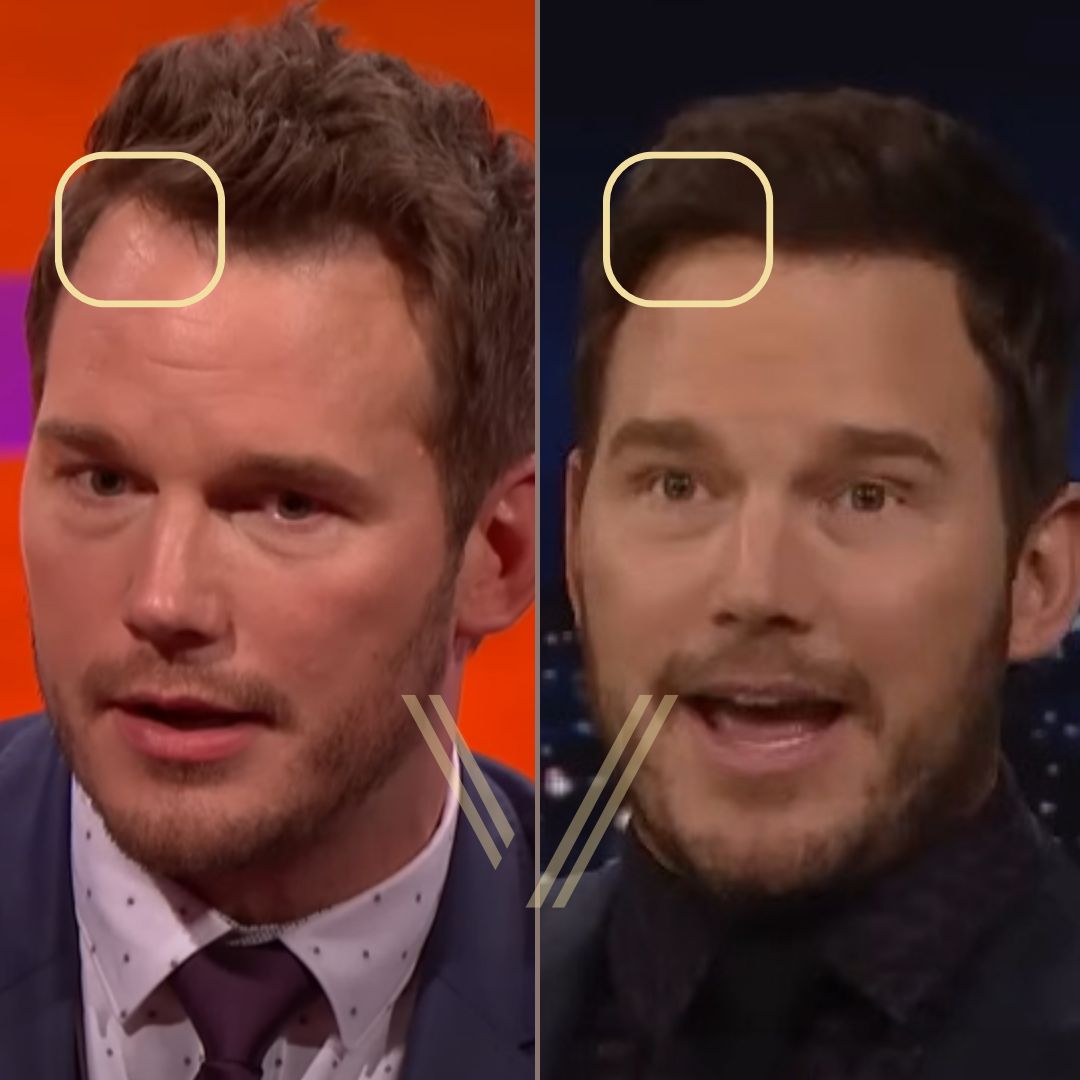 Chris Pratt Hair Transplant