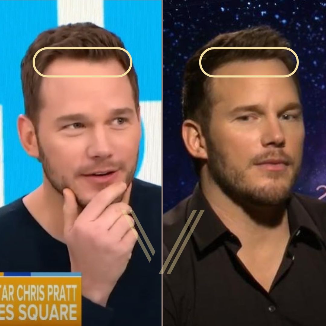 Chris Pratt Hair Transplant