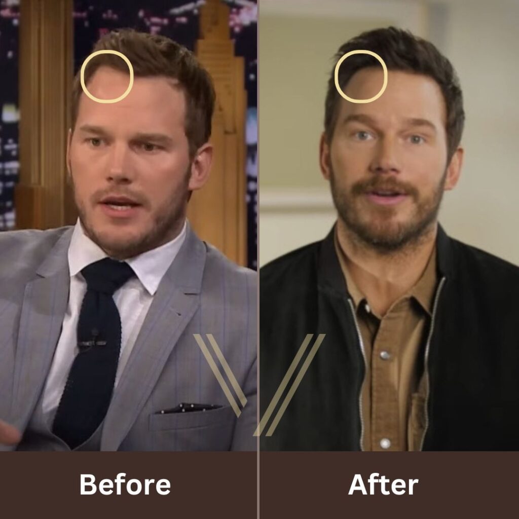 Chris Pratt Hair Transplant