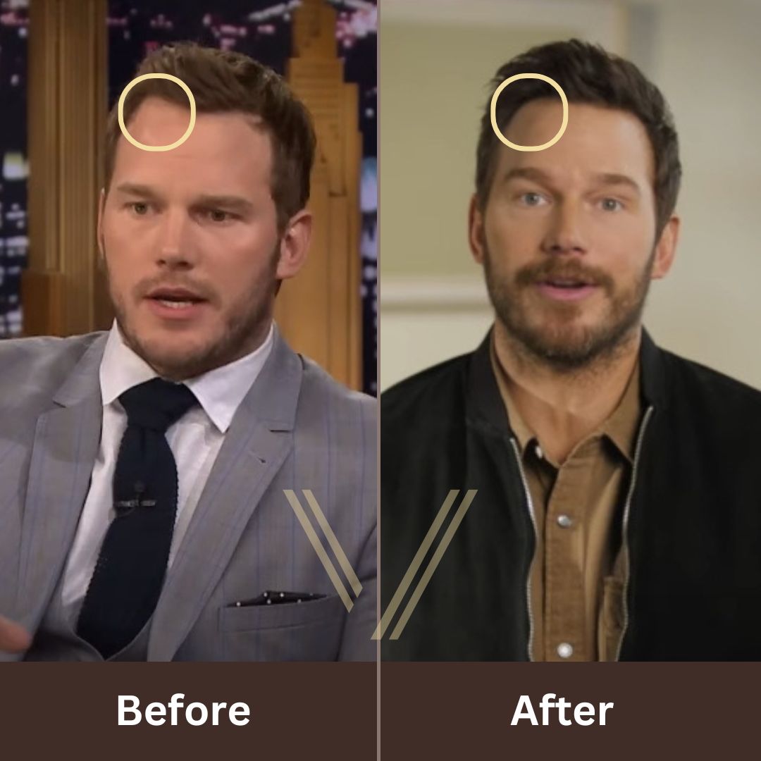 Chris Pratt Hair Transplant