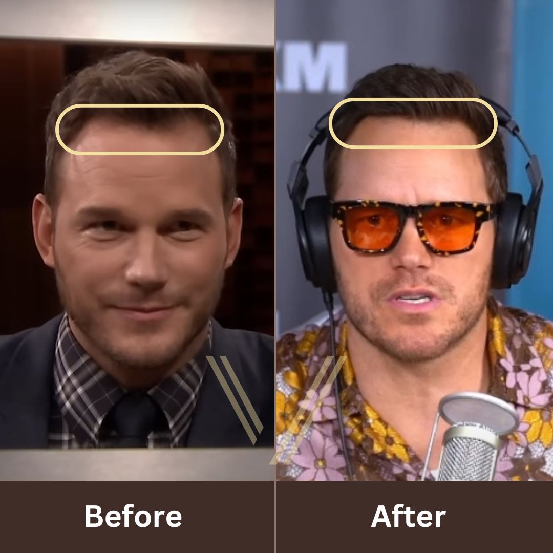 Chris Pratt Hair Transplant