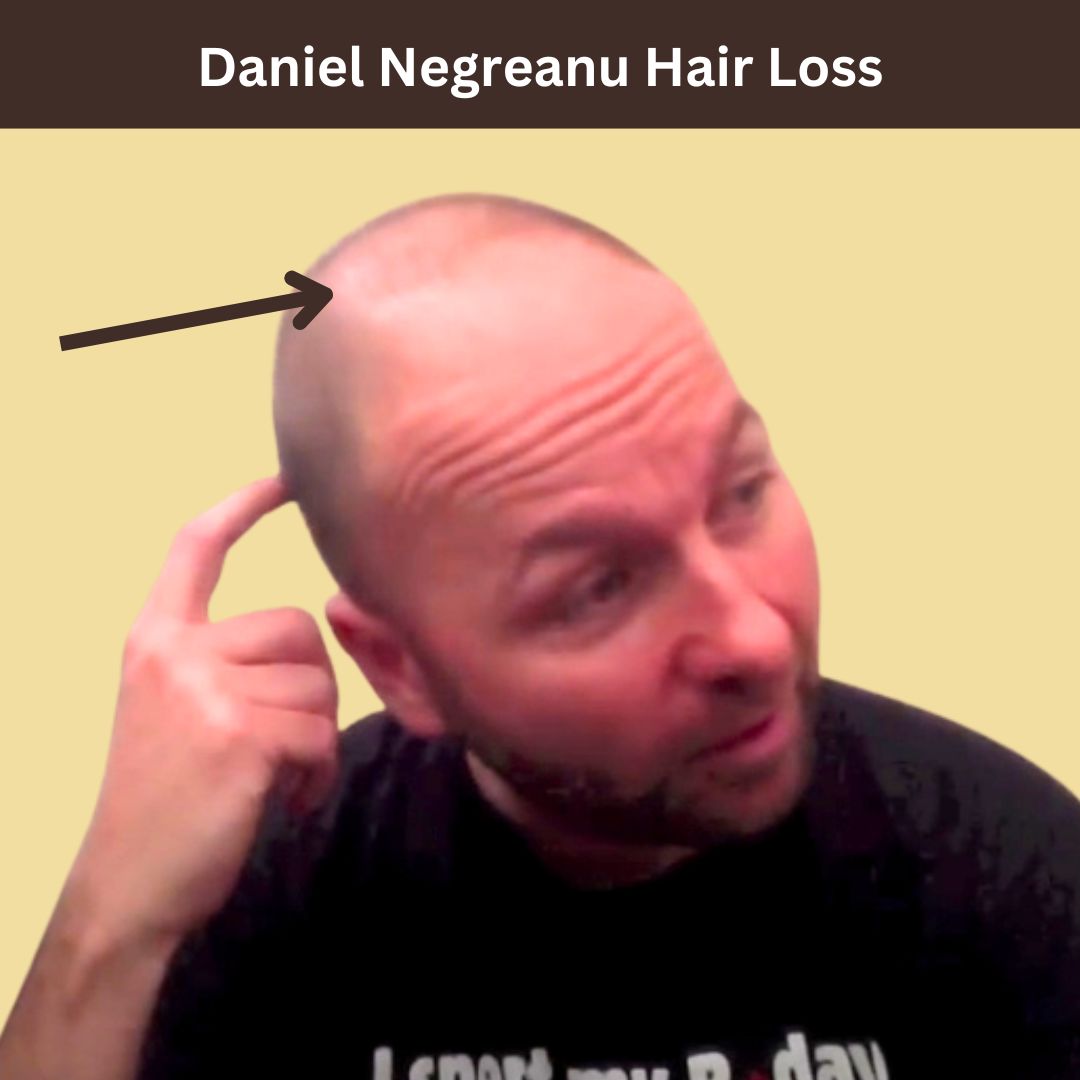 Daniel Negreanu Hair Transplant