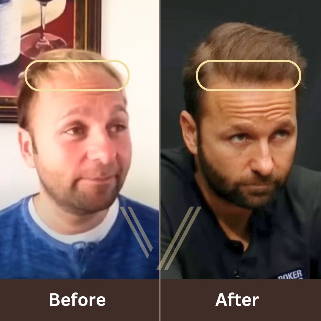Daniel Negreanu Hair Transplant
