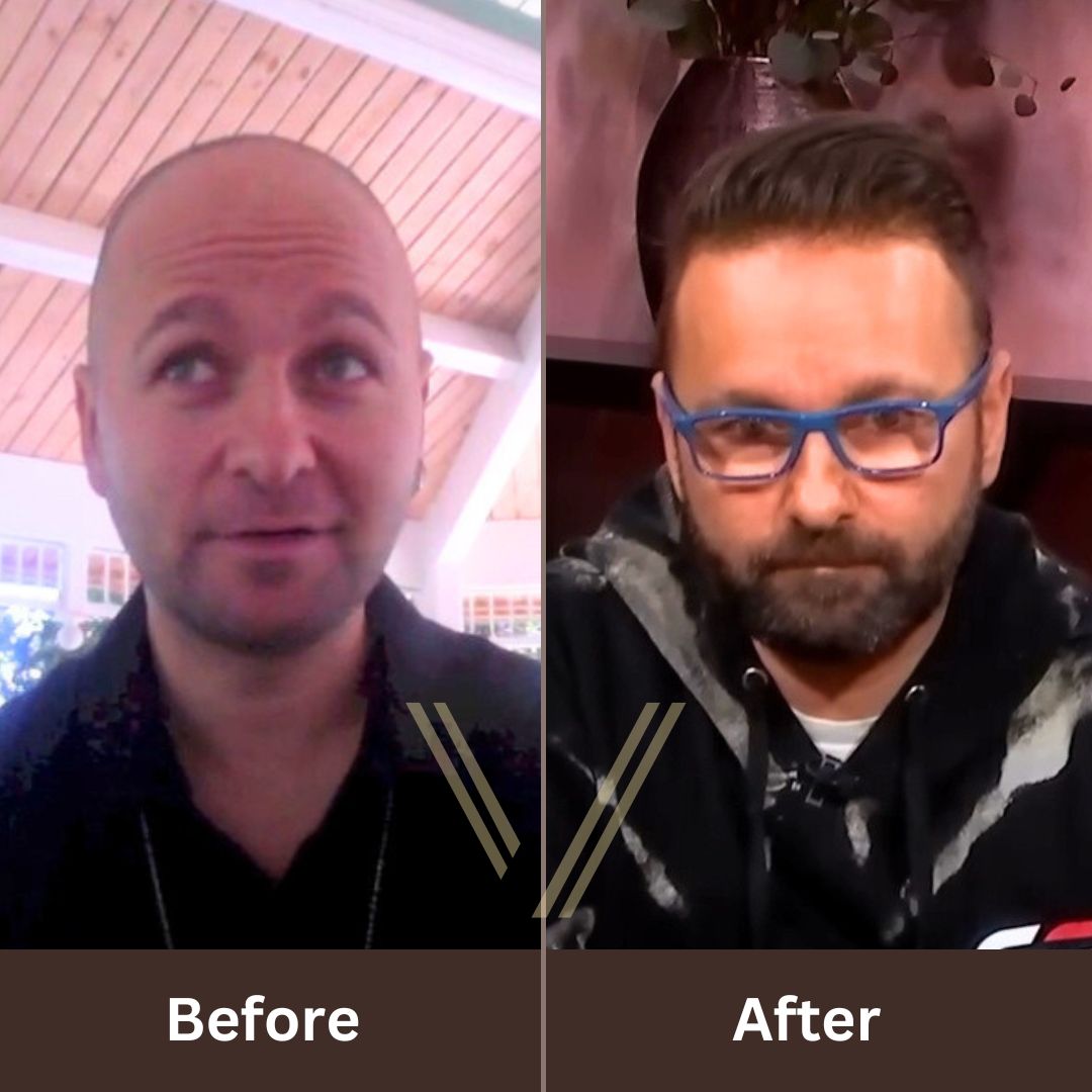 Daniel Negreanu Hair Transplant