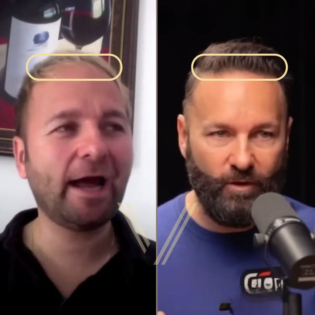 Daniel Negreanu Hair Transplant