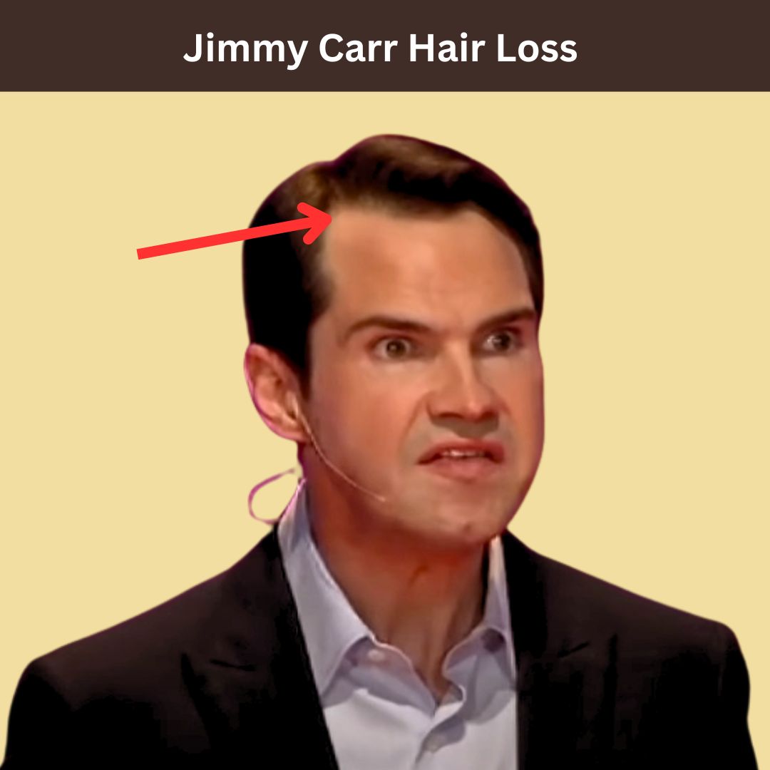 Jimmy Carr Hair Transplant: Before and After Transformation