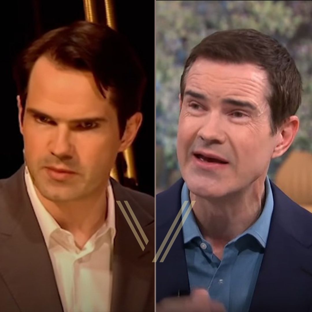 Jimmy Carr Hair Transplant: Before and After Transformation