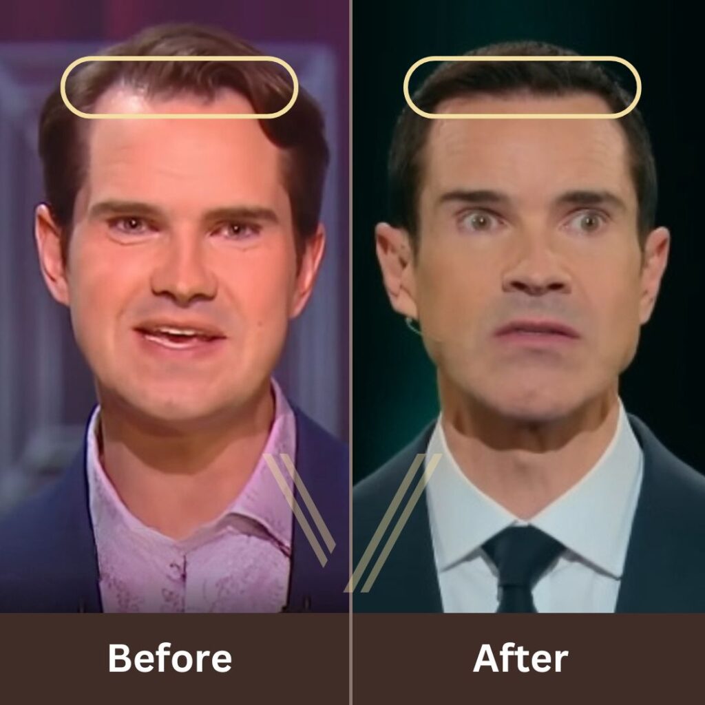 Jimmy Carr Hair Transplant: Before and After Transformation