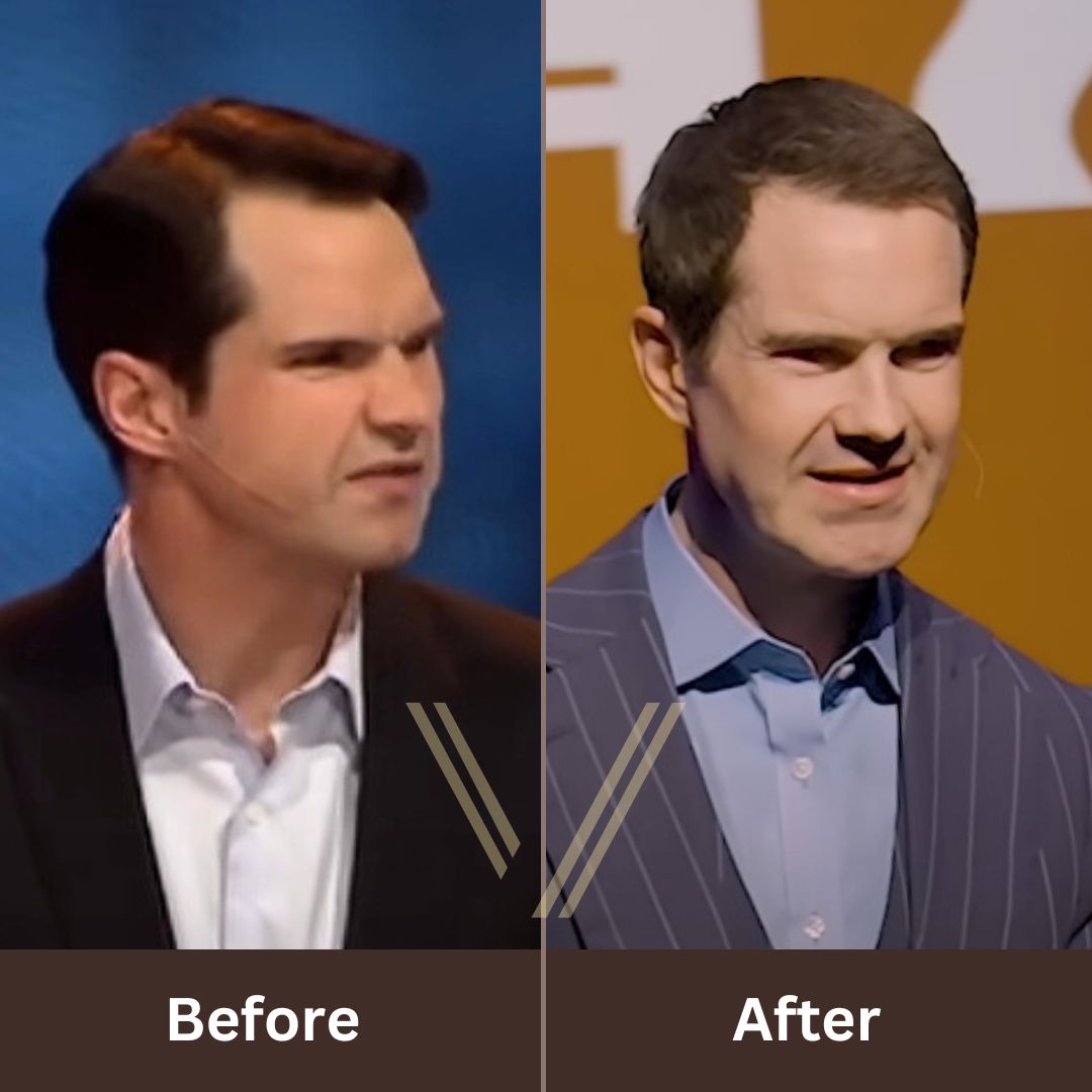 Jimmy Carr Hair Transplant: Before and After Transformation