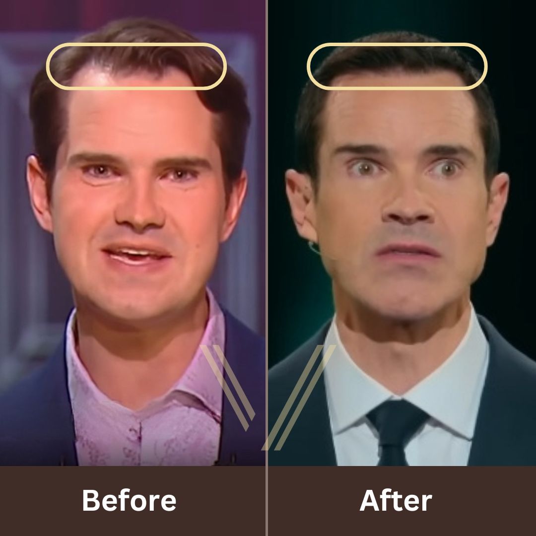Jimmy Carr Hair Transplant: Before and After Transformation