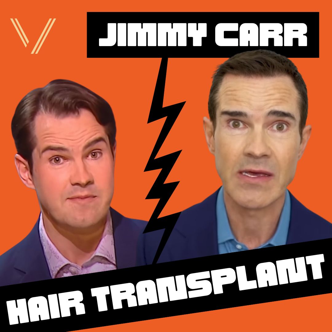 Jimmy Carr Hair Transplant: Before and After Transformation