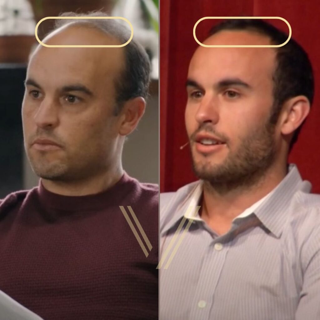 Landon Donovan Hair Transplant
