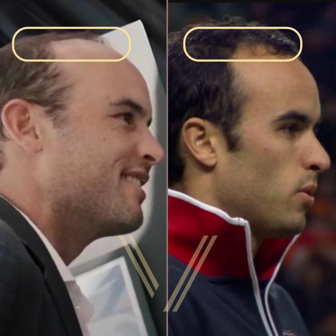 Landon Donovan Hair Transplant