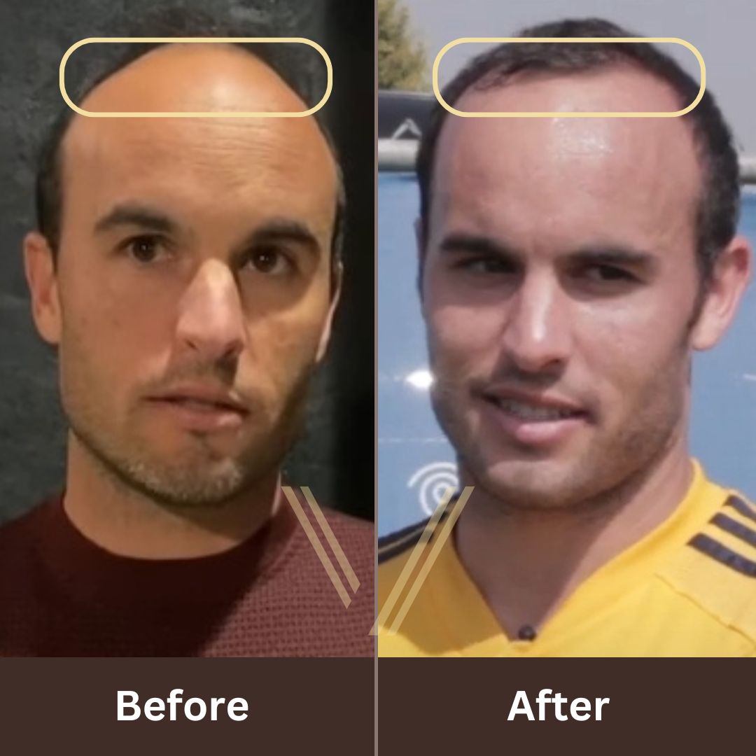 Landon Donovan Hair Transplant
