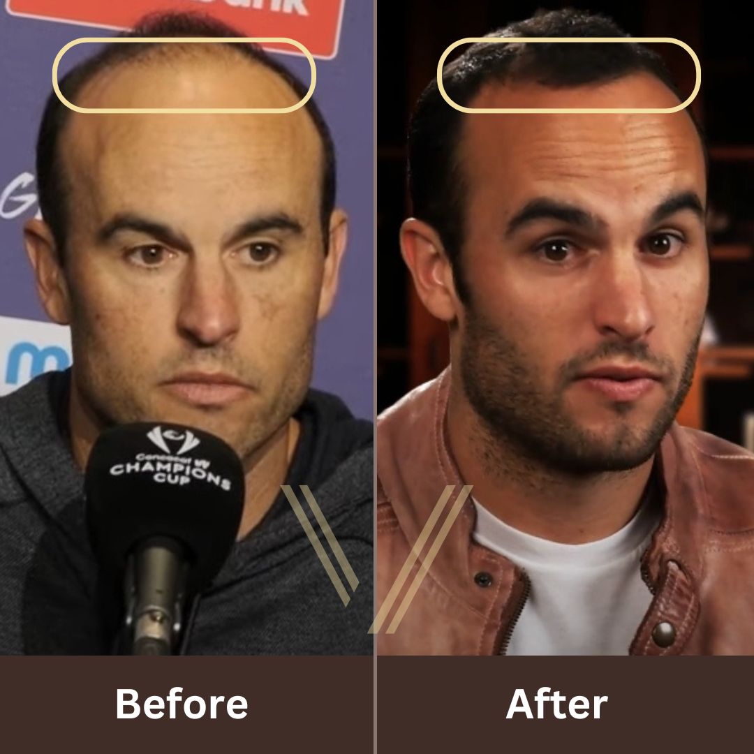 Landon Donovan Hair Transplant