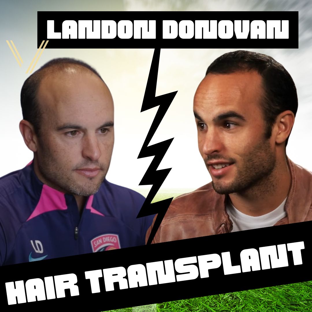 Landon Donovan Hair Transplant