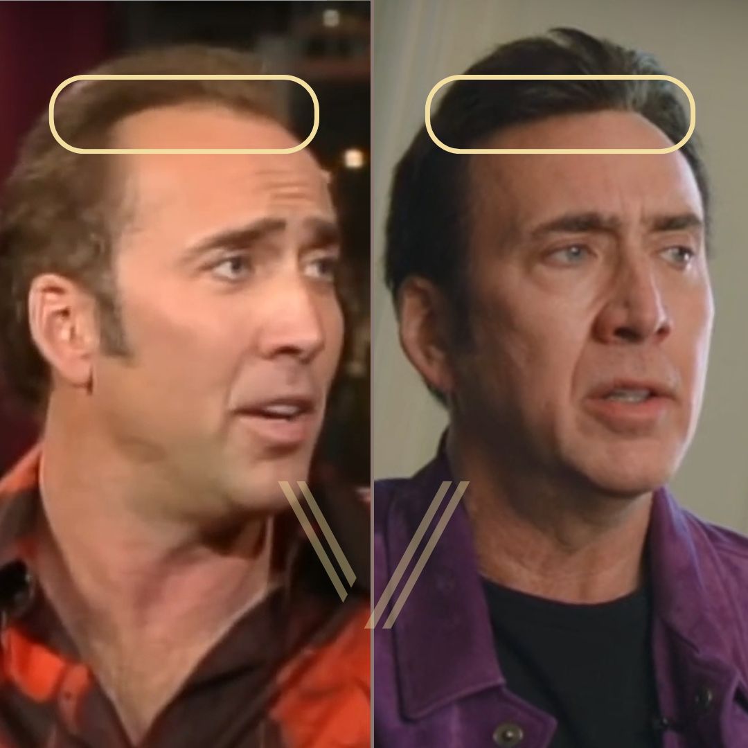 Nicolas Cage Hair Transplant: Before and After Transformation