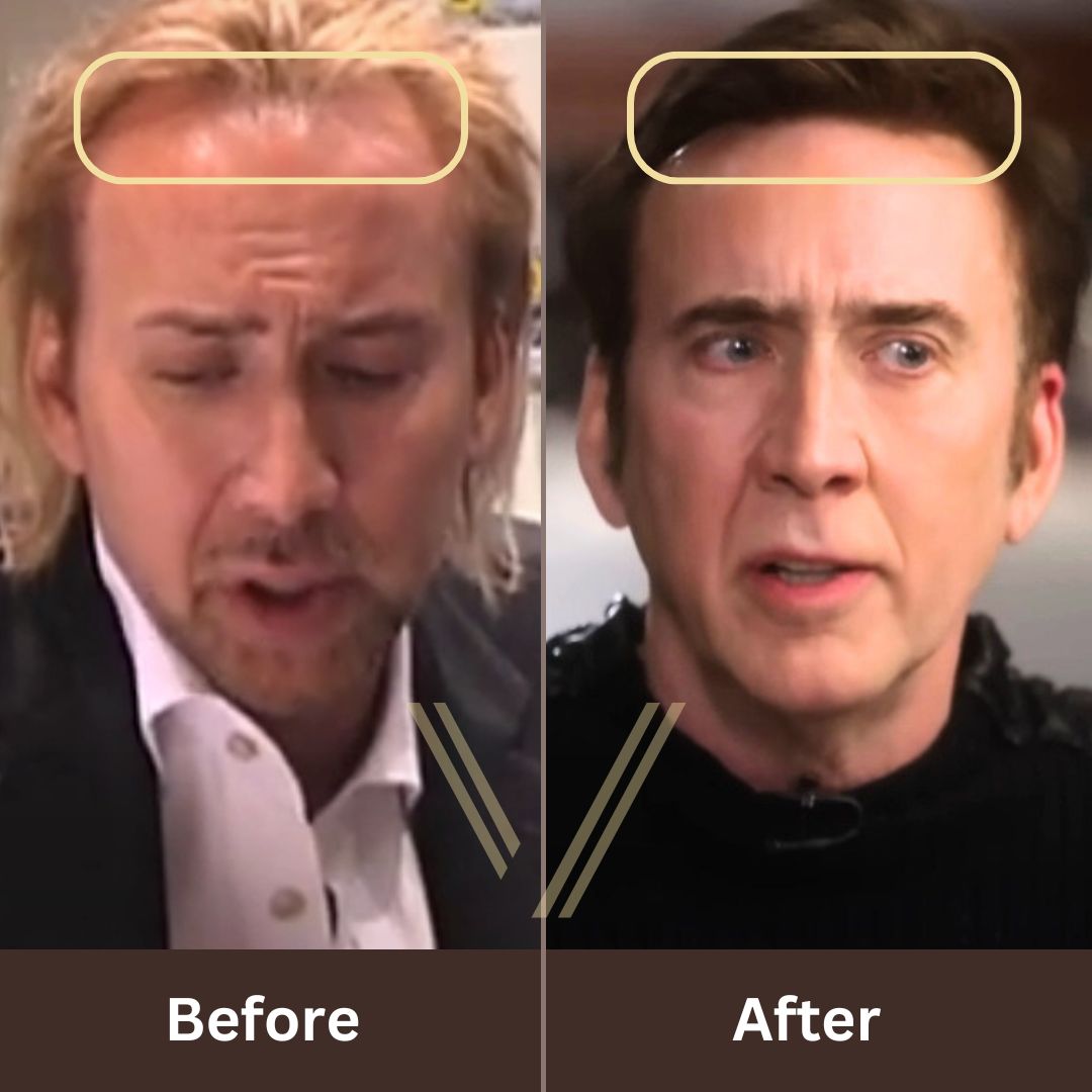 Nicolas Cage Hair Transplant: Before and After Transformation