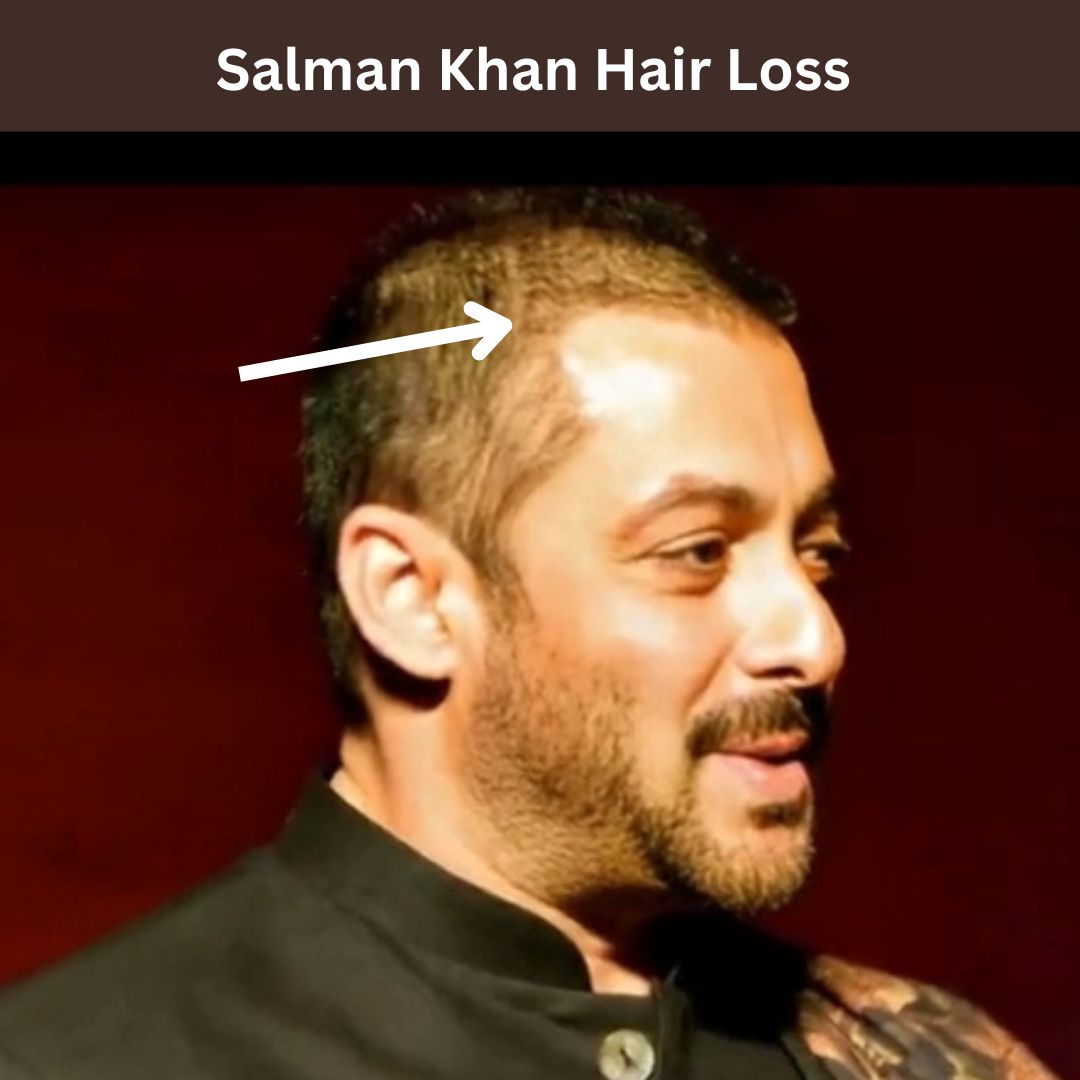 Salman Khan Hair Transplant: Before and After Transformation