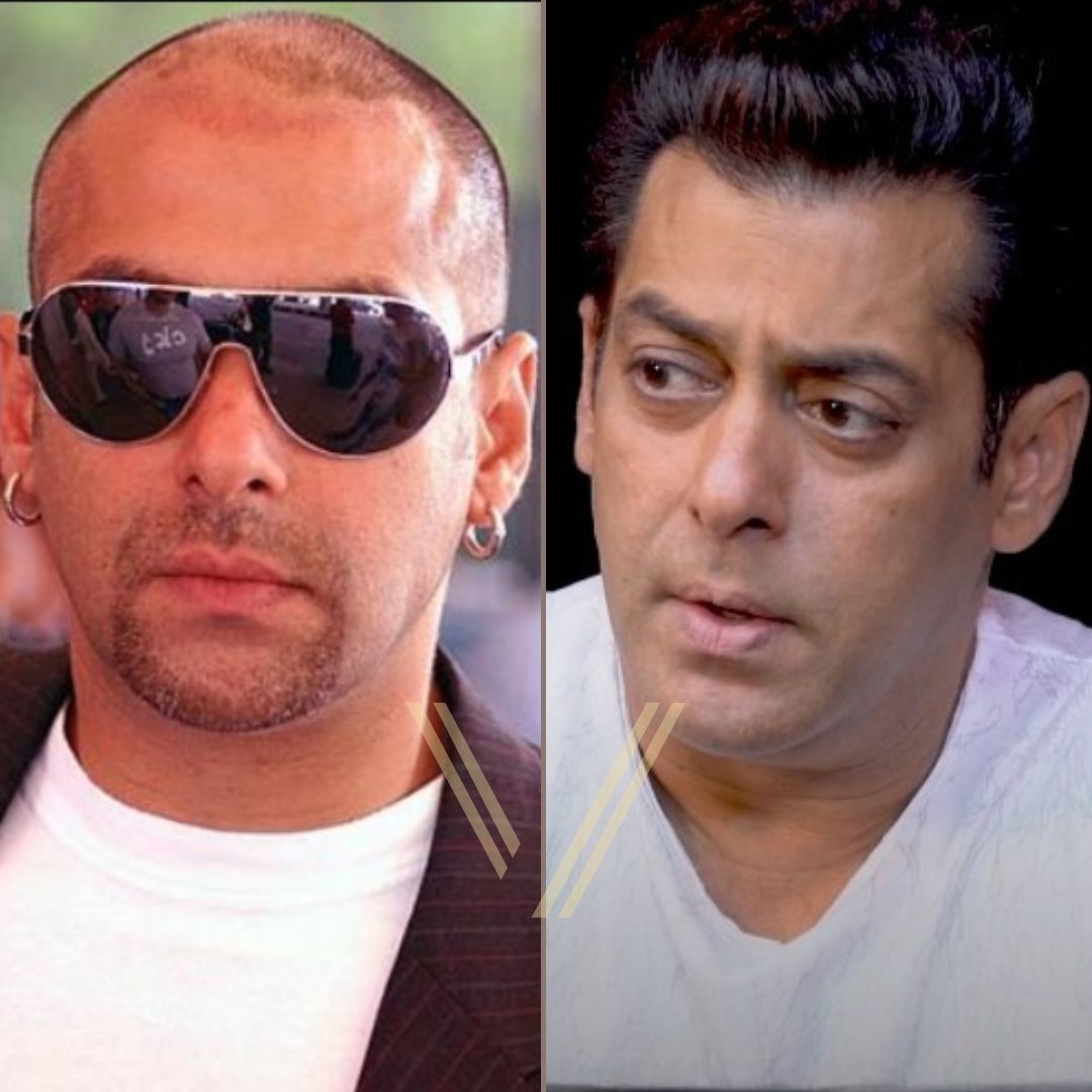 Salman Khan Hair Transplant: Before and After Transformation