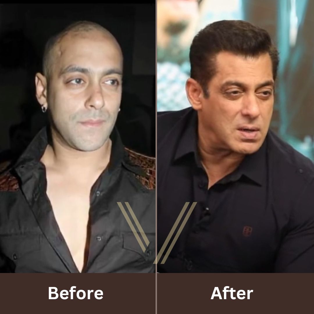 Salman Khan Hair Transplant: Before and After Transformation