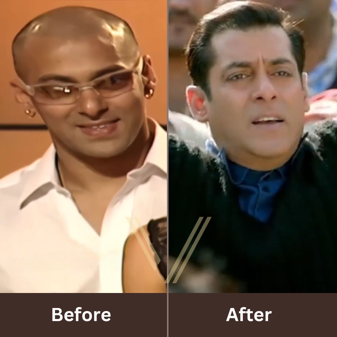Salman Khan Hair Transplant: Before and After Transformation