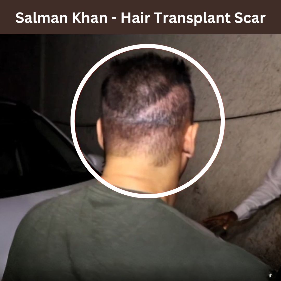 Salman Khan Hair Transplant: Before and After Transformation