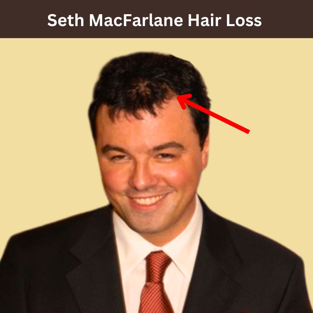 Seth MacFarlane Hair Transplant: Before and After Transformation