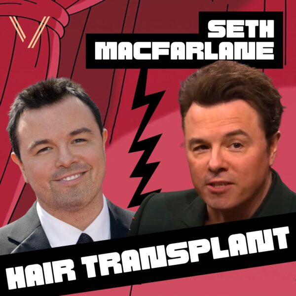 Seth MacFarlane Hair Transplant: Before and After Transformation