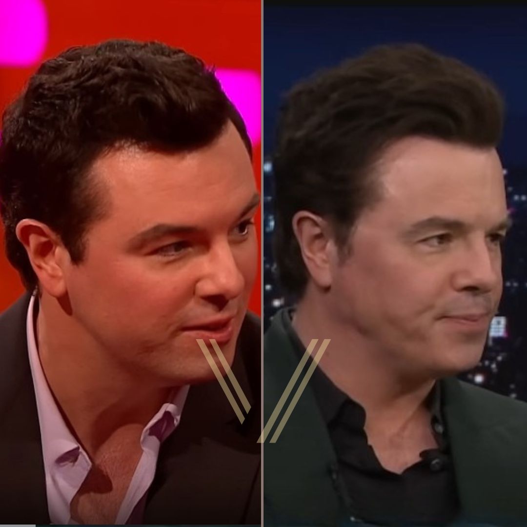 Seth MacFarlane Hair Transplant: Before and After Transformation
