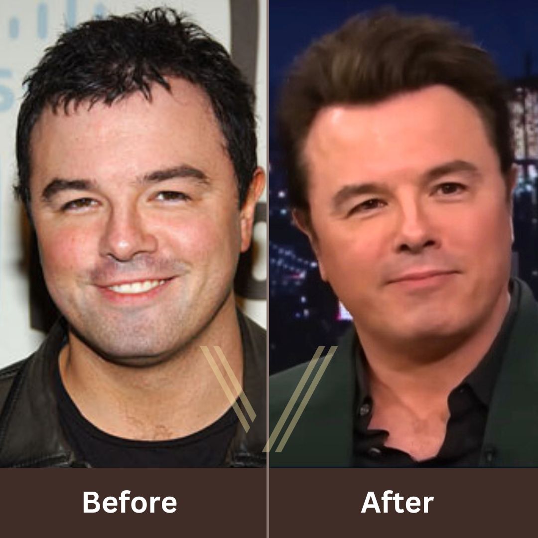 Seth MacFarlane Hair Transplant: Before and After Transformation