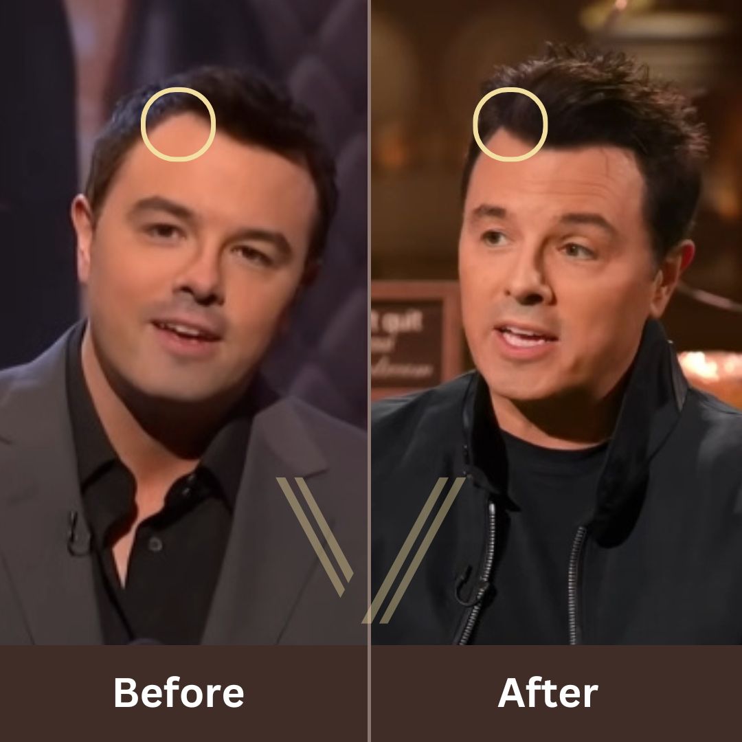 Seth MacFarlane Hair Transplant: Before and After Transformation