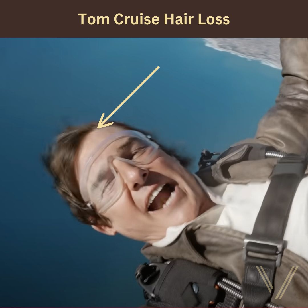Tom Cruise Hair Transplant: Before and After Transformation