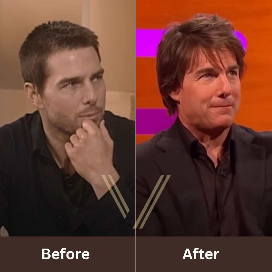 Tom Cruise Hair Transplant: Before and After Transformation